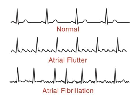 Atrial Flutter Ecg Causes Treatment Nursing Nclex Acls Heart Rhythm