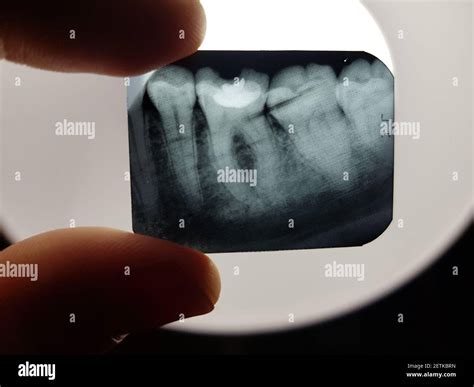 Tooth Cavity Xray