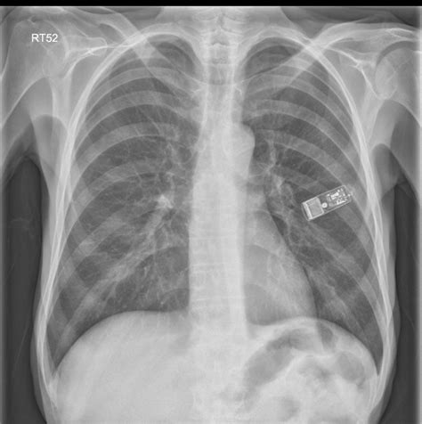 Implantable Loop Recorder Pacs