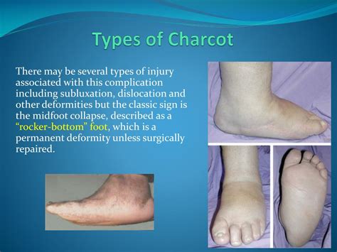 Ppt Assessing Charcot Foot In The Diabetic Patient With Peripheral
