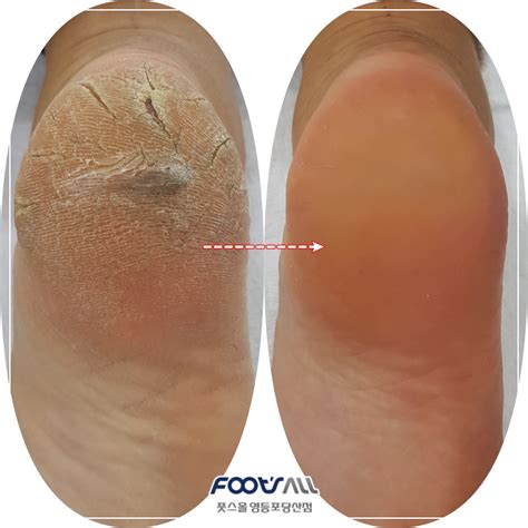 갈라지는 발바닥 각질이 무좀 때문 풋스올 Natural Foot Therapy