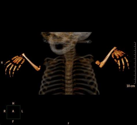 Radial Ray Defects Pacs