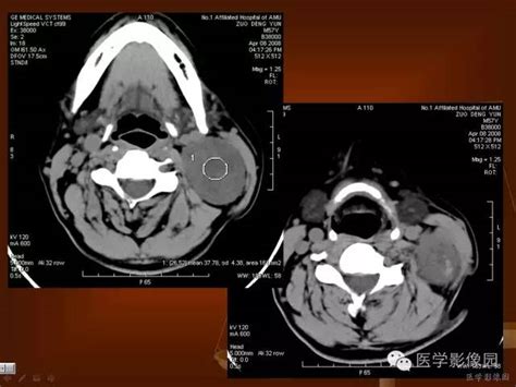 【病例】左颈部神经鞘瘤1例ct影像表现 影像ppt