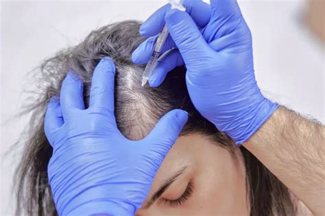 What Is Lupus Hair Loss Symptoms Treatments Patterns