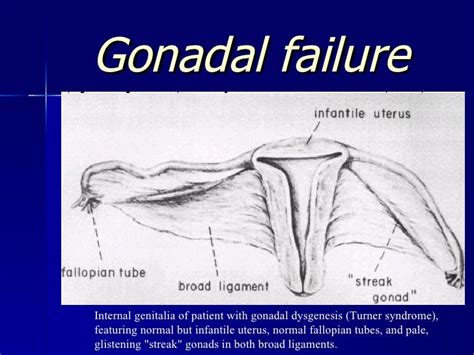 Streak Gonad 画像 Streak Gonad Definition Ejla