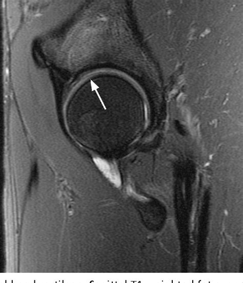 Figure 3 From Hip Femoral Acetabular Impingement Semantic Scholar