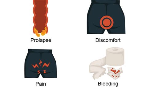 How To Cure Hemorrhoids Quickly And Easily Uk