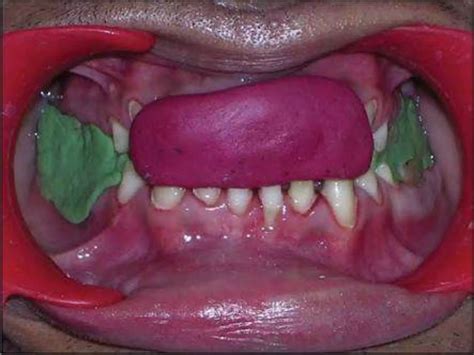 Articulators Parts Classification Limitations Pptx Dental Health Diseases And Conditions