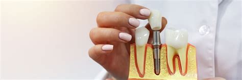 The Importance Of Bone Density For Dental Implants Ds