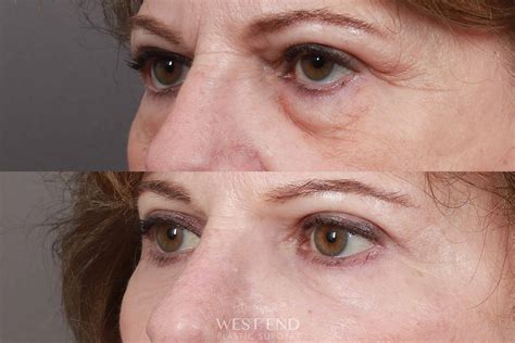 Lower And Upper Blepharoplasty Case 10243 West End Plastic Surgery
