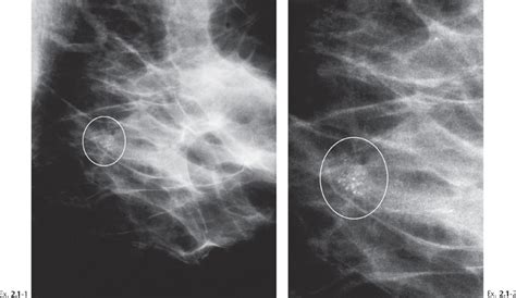 Group 1 One Or Two Clusters Of Crushed Stone Like Calcifications Of The Mammogram Produced By