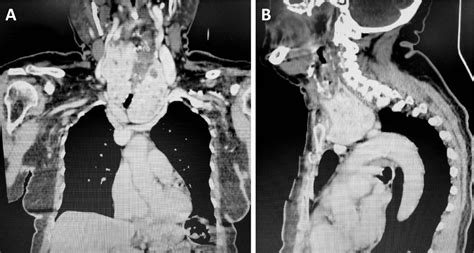Ectopic Thyroid In The Anterior Mediastinum Resected Through A Video