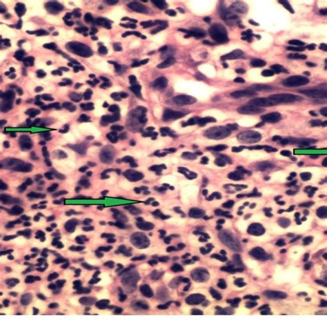 Profuse Fibrous Connective Tissue Mild Infiltration Of Inflammatory