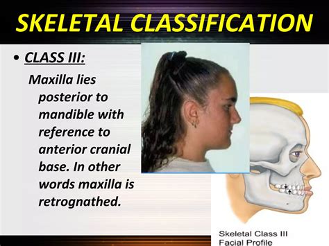 Classification Of Malocclusion Ppt