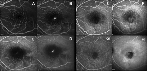 Fag Icg Findings In The Acute And Final Phase Of The Disease A D Fa