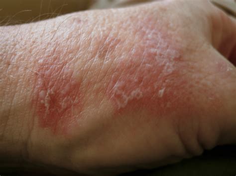 Phytophotodermatitis And The Fig Tree From Hades John Clarke Online