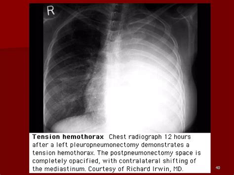 Sequelae And Complications Of Pneumonectomy Ppt