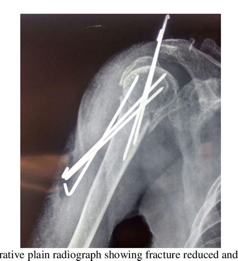 Percutaneous Fixation Of Proximal Humeral Fractures Musculoskeletal Key My Xxx Hot Girl
