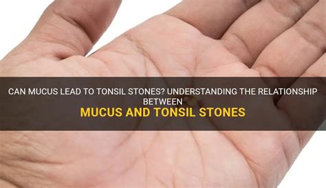 Can Mucus Lead To Tonsil Stones Understanding The Relationship Between