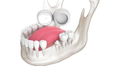 Graus De Perda óssea Dentária RETOEDU