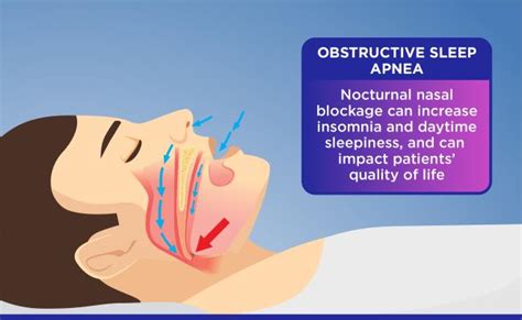 Nasal Obstruction At Night And Its Health Impact In Patients With