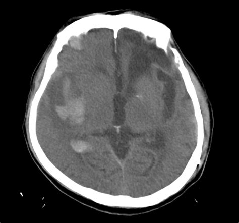 Stroke Diagnosis And Treatment Samsung Medical Center