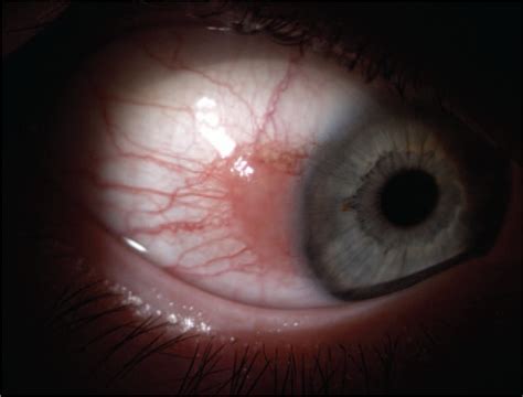 Conjunctival Papilloma Treatment