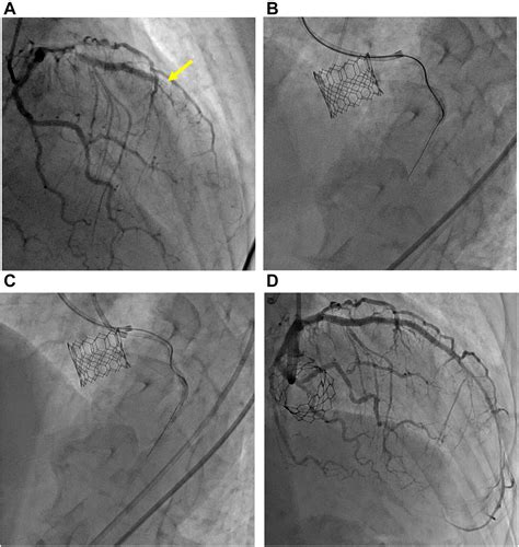 Guiding Catheter For Angiography At Jai Reading Blog