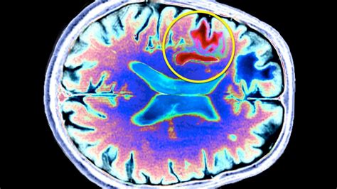 Progressive Multifocal Leukoencephalopathy Treatment Market Focuses On