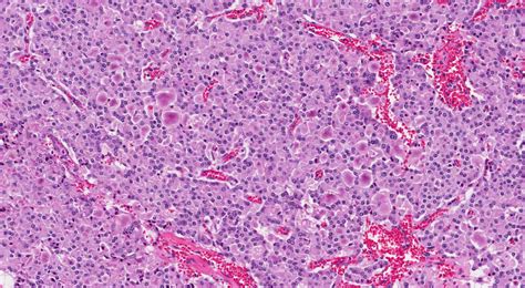 Neuroendocrine Tumours Neuroendokrine Tumoren Symptome Cnqi