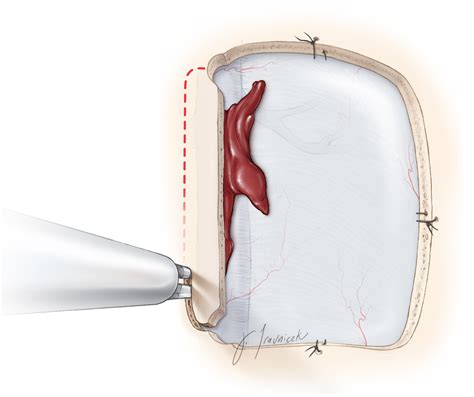 Lacerated Dural Venous Sinus Repair The Neurosurgical Atlas