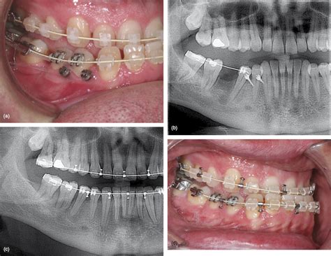8 Molar Protraction Pocket Dentistry