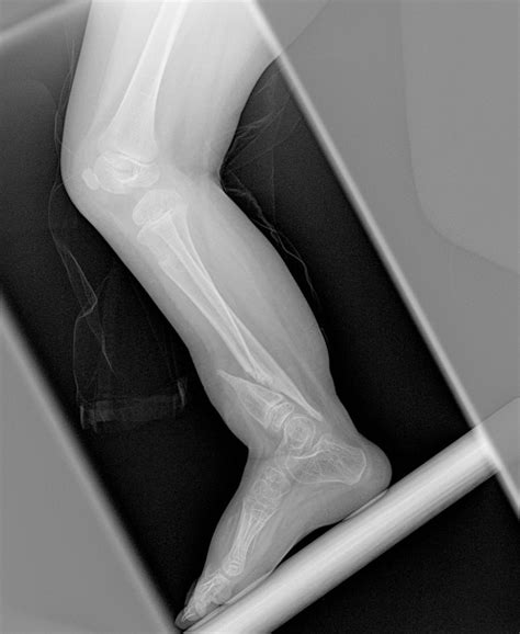 year old girl with CPT CLLC Montréal Dre Marie Gdalevitch