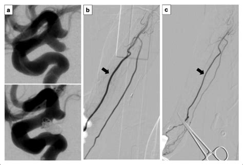 A 73 Year Old Woman Underwent Coil Embolization With Stent Assisted
