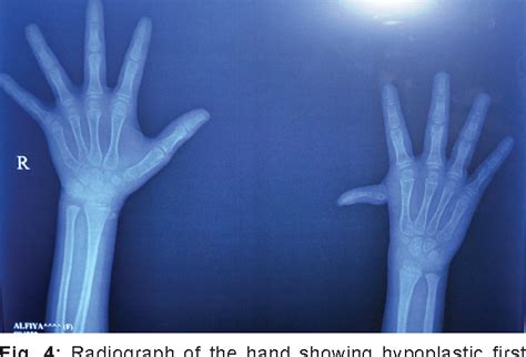 Figure 1 From A Rare Clinical Variant Of Oromandibular Limb Hypogenesis