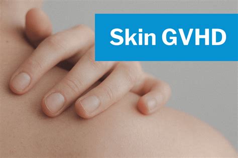 Skin Gvhd The Meredith A Cowden Foundation