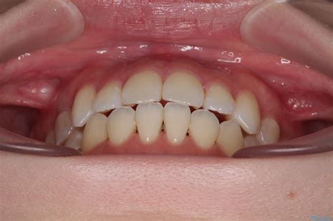 舌突出癖による開咬 舌のトレーニングを行いながら前歯の隙間を改善｜（医）精密審美会