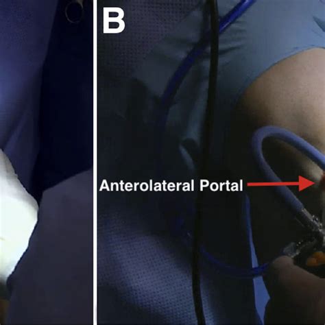 Image Showing An Arthroscopic Patellar Facetectomy In A Right Knee