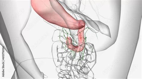 Duodenal Carcinoma Also Known As Small Intestine Adenocarcinoma Is A