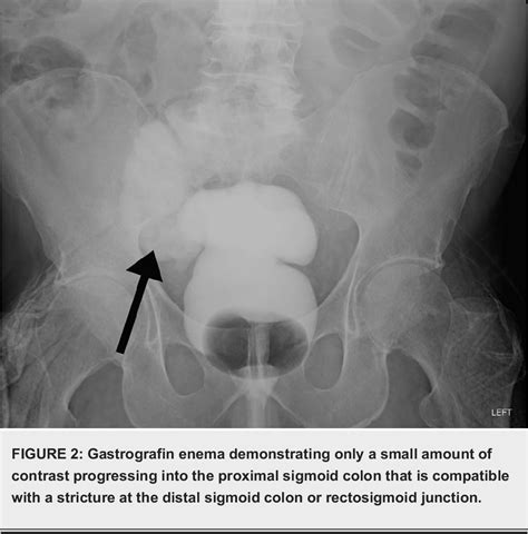 Figure 2 From Robotic Sigmoidectomy Of A Rare Instance Of Sigmoid Colon