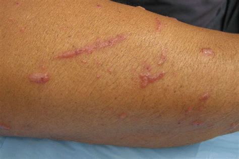 Poison Sumac Rash Pictures Causes Prevention