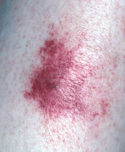 Vascular Rash