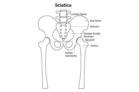Sciatica Science Design Vector Diagram Graphic By Hamjaiu · Creative