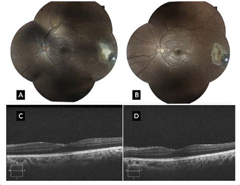 Ultra Wide Field Images Before A And After B Treatment Optical