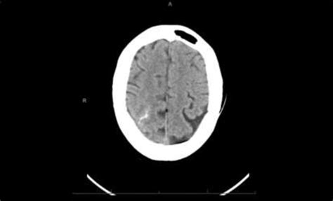 Non Contrast Ct Of The Brain Demonstrates An Area Of Increased