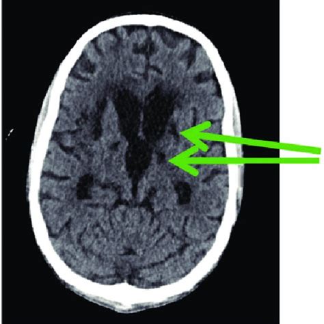 Non Contrast Computed Tomography Scan Of The Brain Showing Bilateral