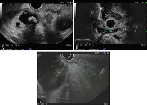 Eus In Bile Duct Gallbladder And Ampullary Lesions Clinical Tree