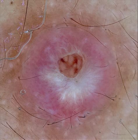 Dermoscopy Of Molluscum Contagiosum With An Orifice Single Lesion In An Adult Cosmoderma