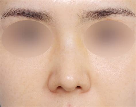 무보형물 귀연골 비중격연골 흡수성콜라겐 기능코2종 전후사진 아베크성형외과