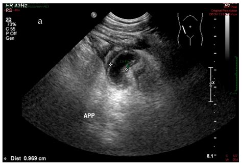 Appendicitis Ultrasound Criteria